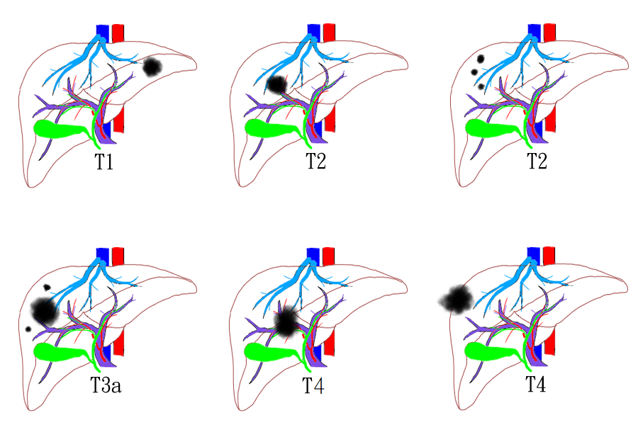 肝癌分期 - 嘉義長庚一般外科